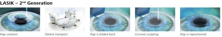 Recovery After Laser Eye Surgery - We Fix Eyes