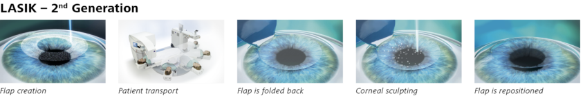 Recovery After Laser Eye Surgery - We Fix Eyes