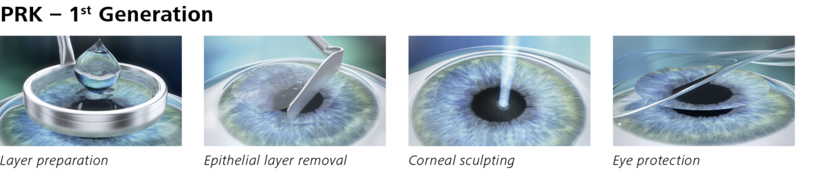 Recovery After Laser Eye Surgery - We Fix Eyes